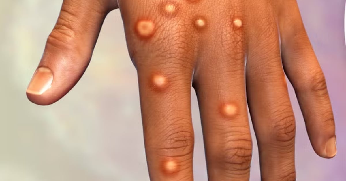 Understanding the Monkeypox Pandemic: What You Need to Know